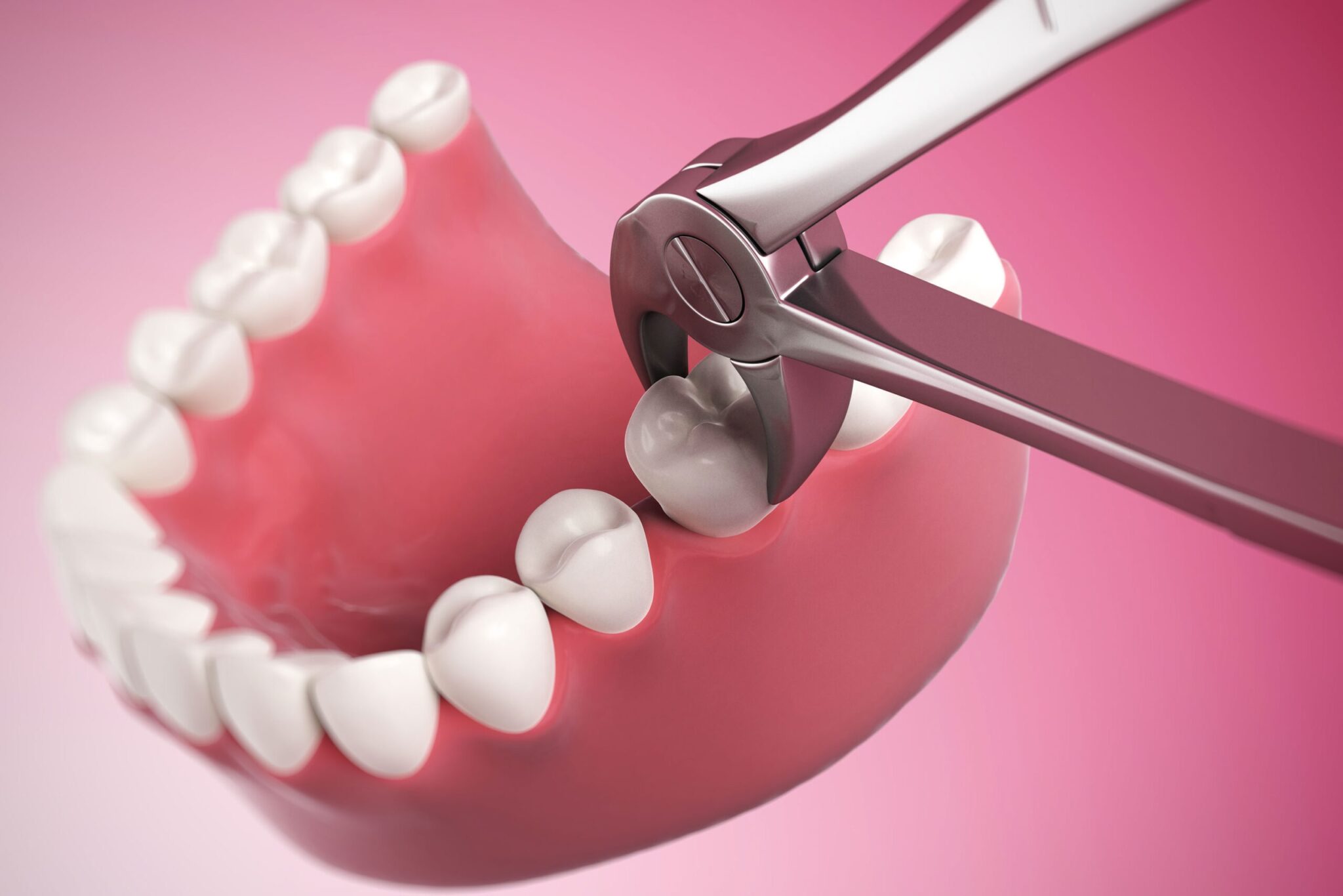Wisdom Tooth Extractions Sherwood Park | Wisdom Tooth Extractions Near You